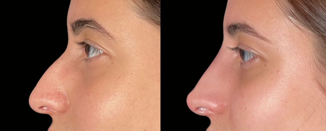 Non-Surgical Nose Job Miami | Liquid Rhinoplasty & Nose Fillers Miami
