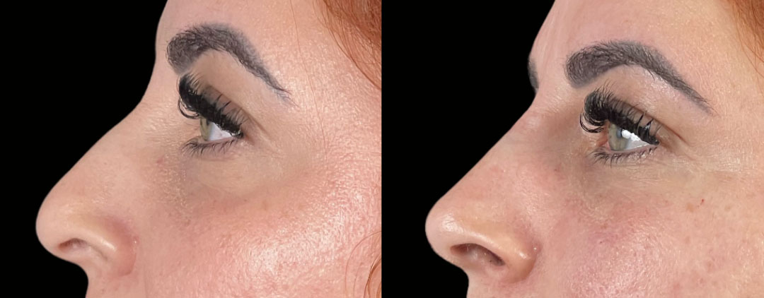 Non Surgical Nose Job Miami | Liquid Rhinoplasty