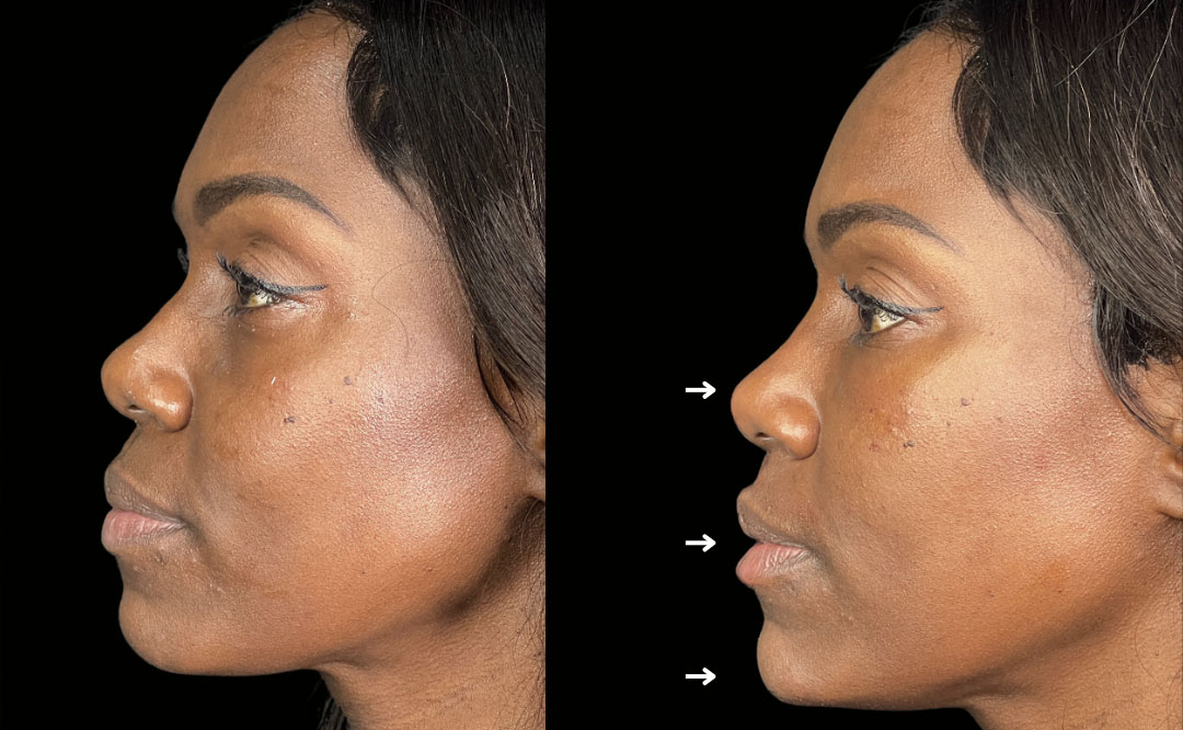 Non Surgical Nose Job Miami | Liquid Rhinoplasty
